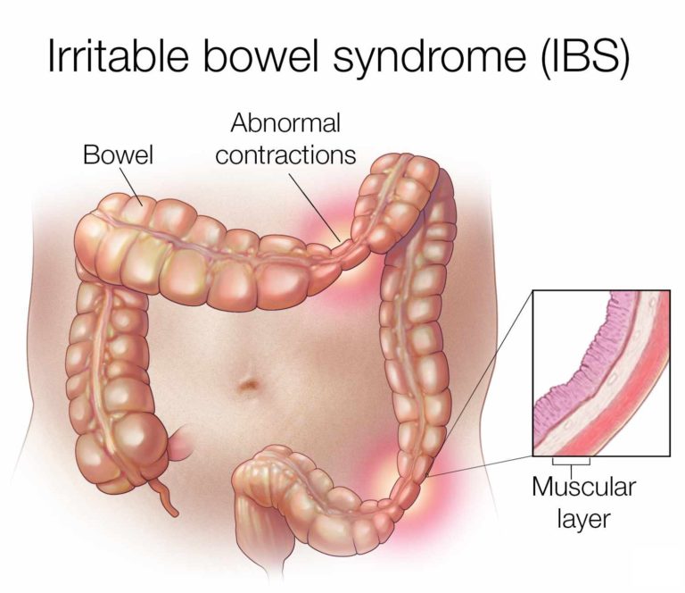 Gastroenterologists In Florida Irritable Bowel Syndrome Gastroenterologists In Florida Irritable Bowel Syndrome